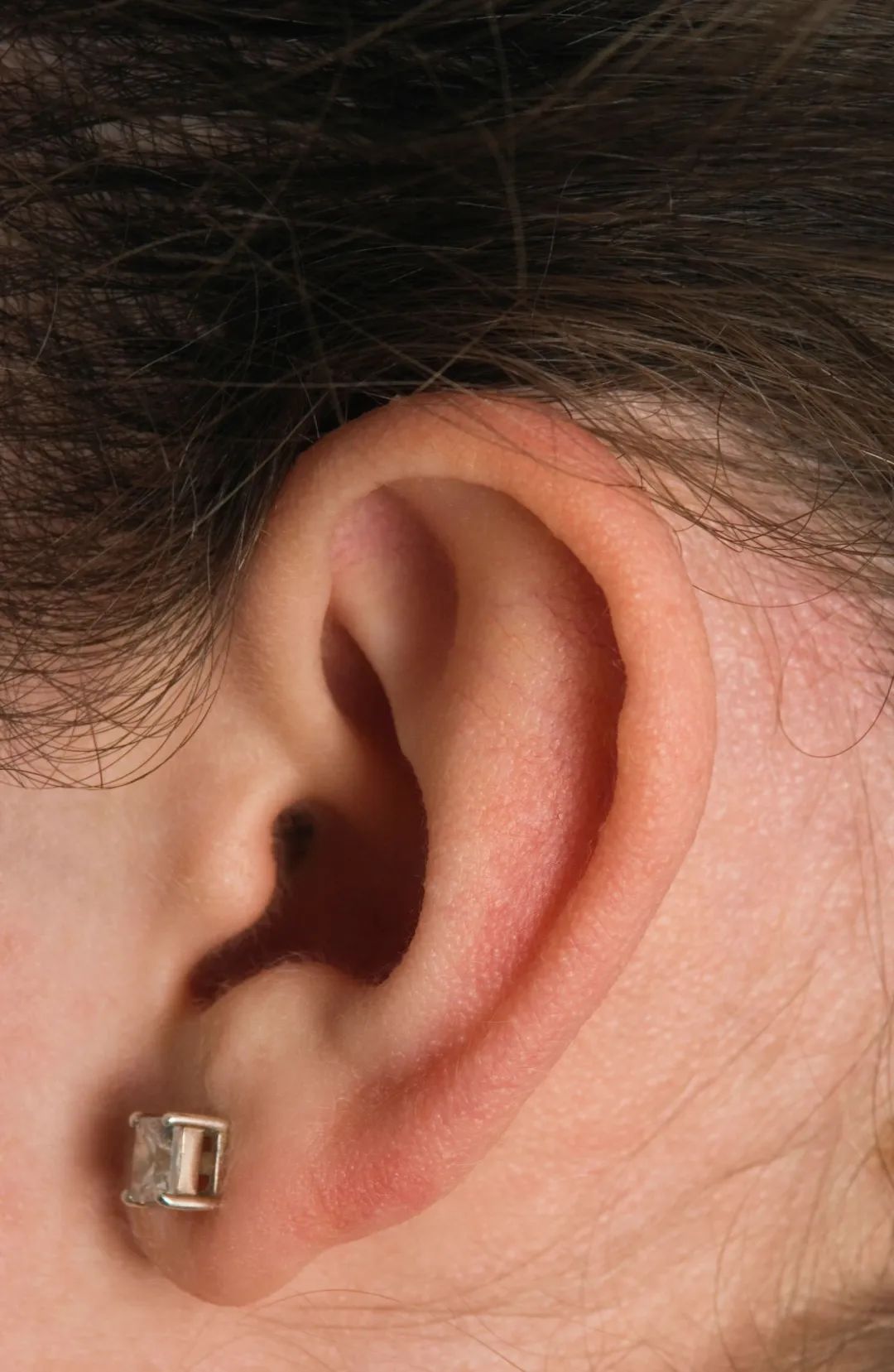 尚医科普：打耳洞引发耳廓软骨膜炎导致畸形？眼耳鼻喉科医院舒易来和陈兵团队发表病例报道